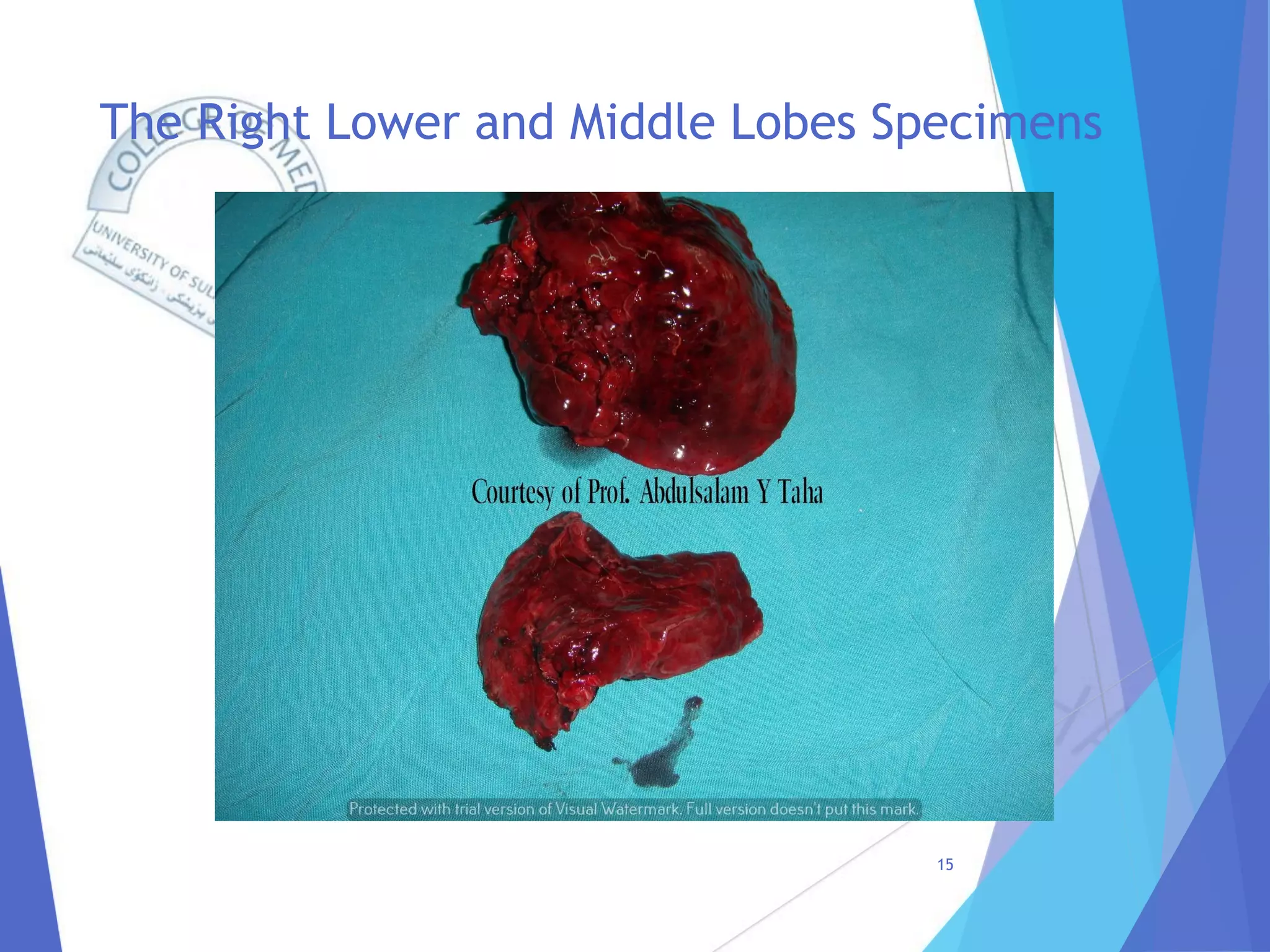 Right Middle and Lower Pulmonary Bilobectomy for Bronchiectasis.pdf