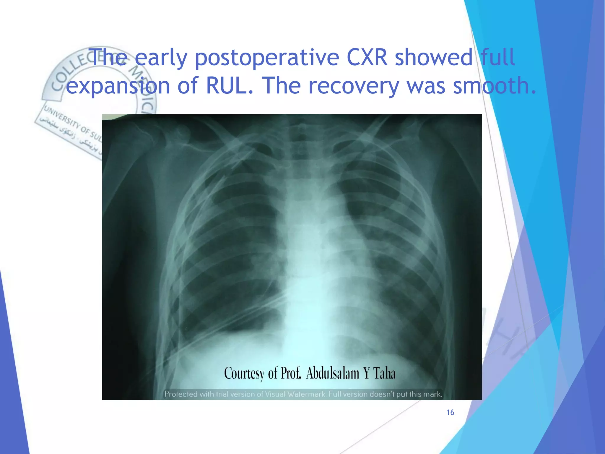 Right Middle and Lower Pulmonary Bilobectomy for Bronchiectasis.pdf