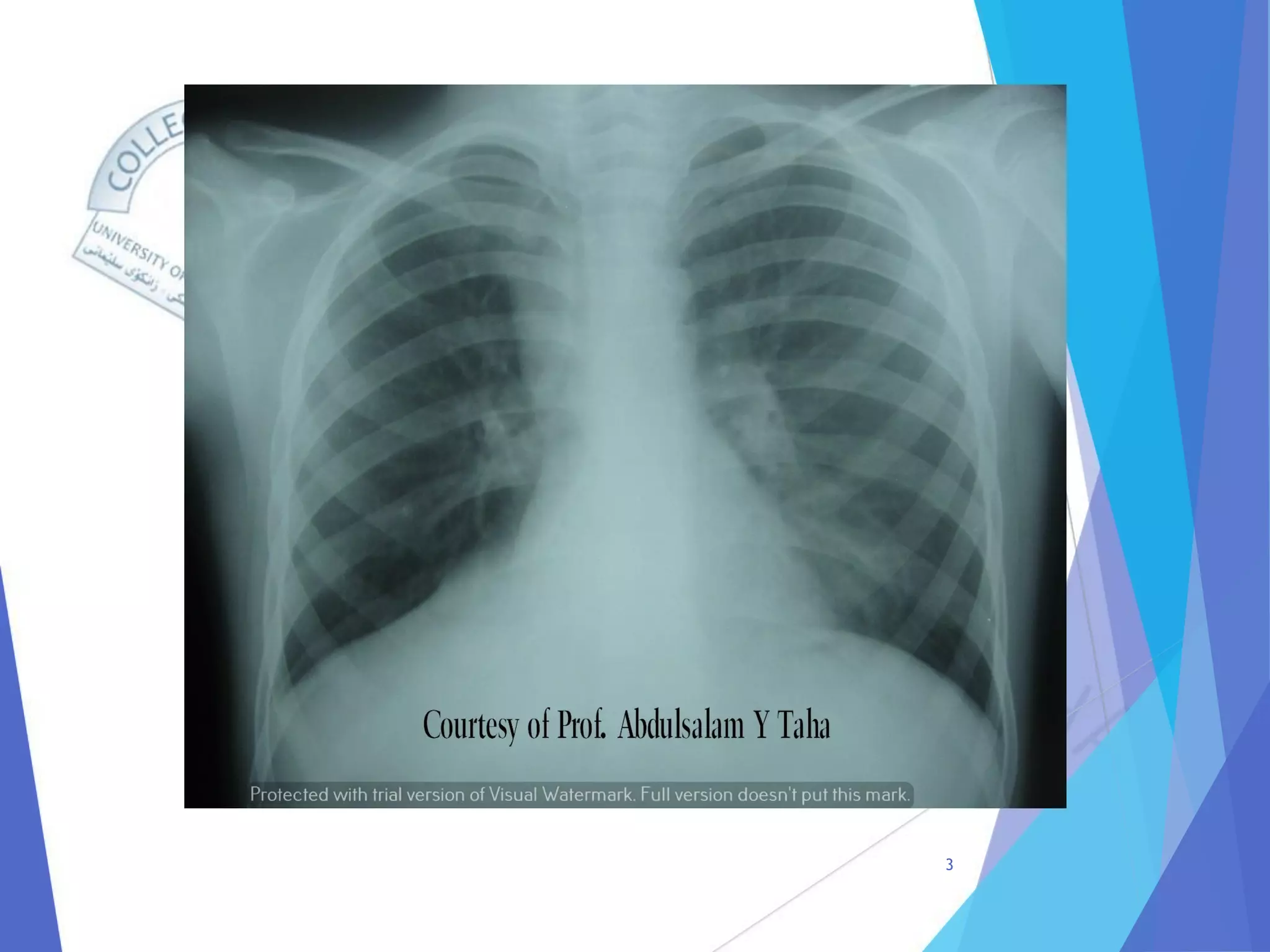 Right Middle and Lower Pulmonary Bilobectomy for Bronchiectasis.pdf