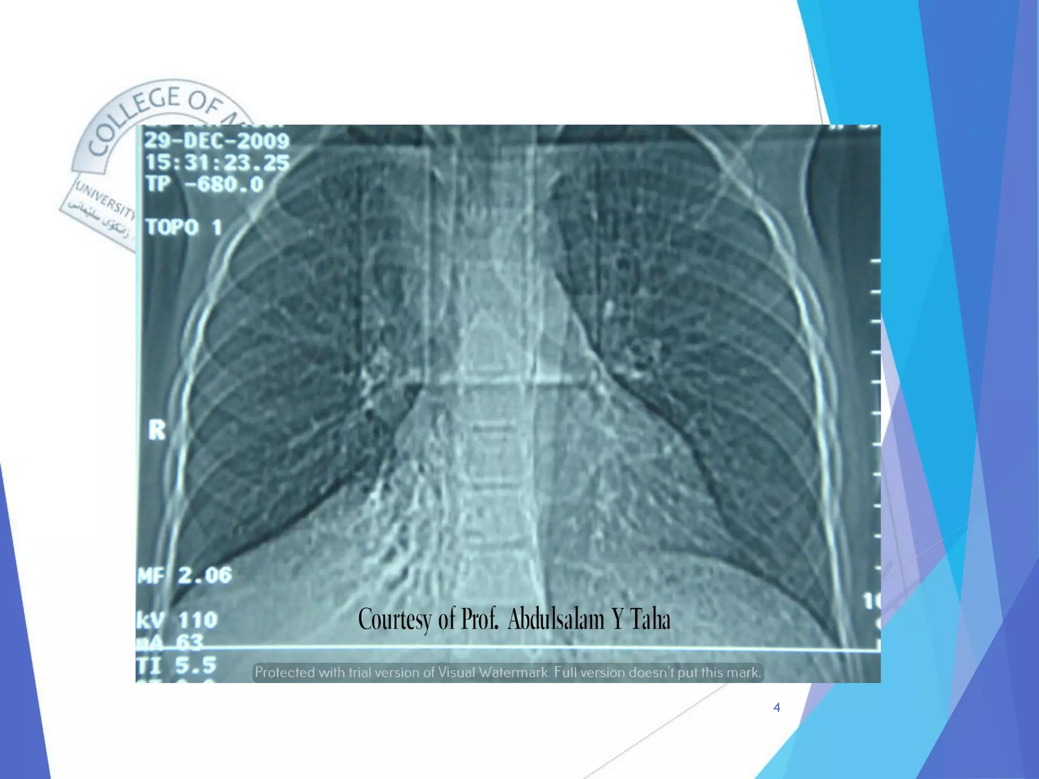 Right Middle and Lower Pulmonary Bilobectomy for Bronchiectasis.pdf
