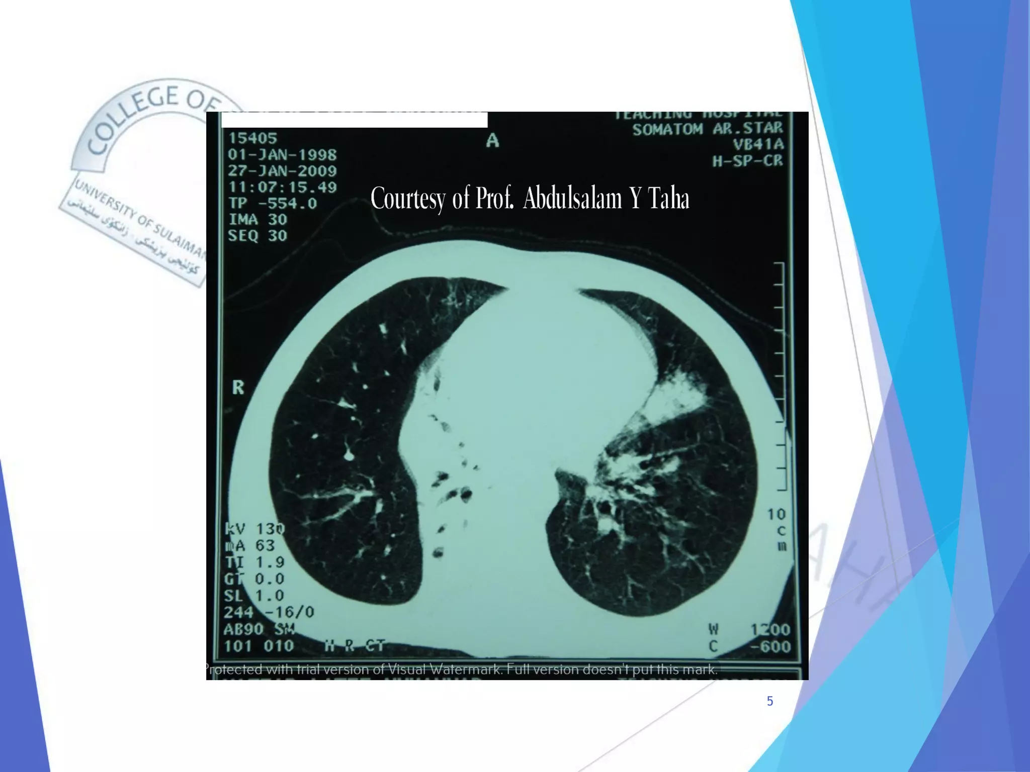 Right Middle and Lower Pulmonary Bilobectomy for Bronchiectasis.pdf