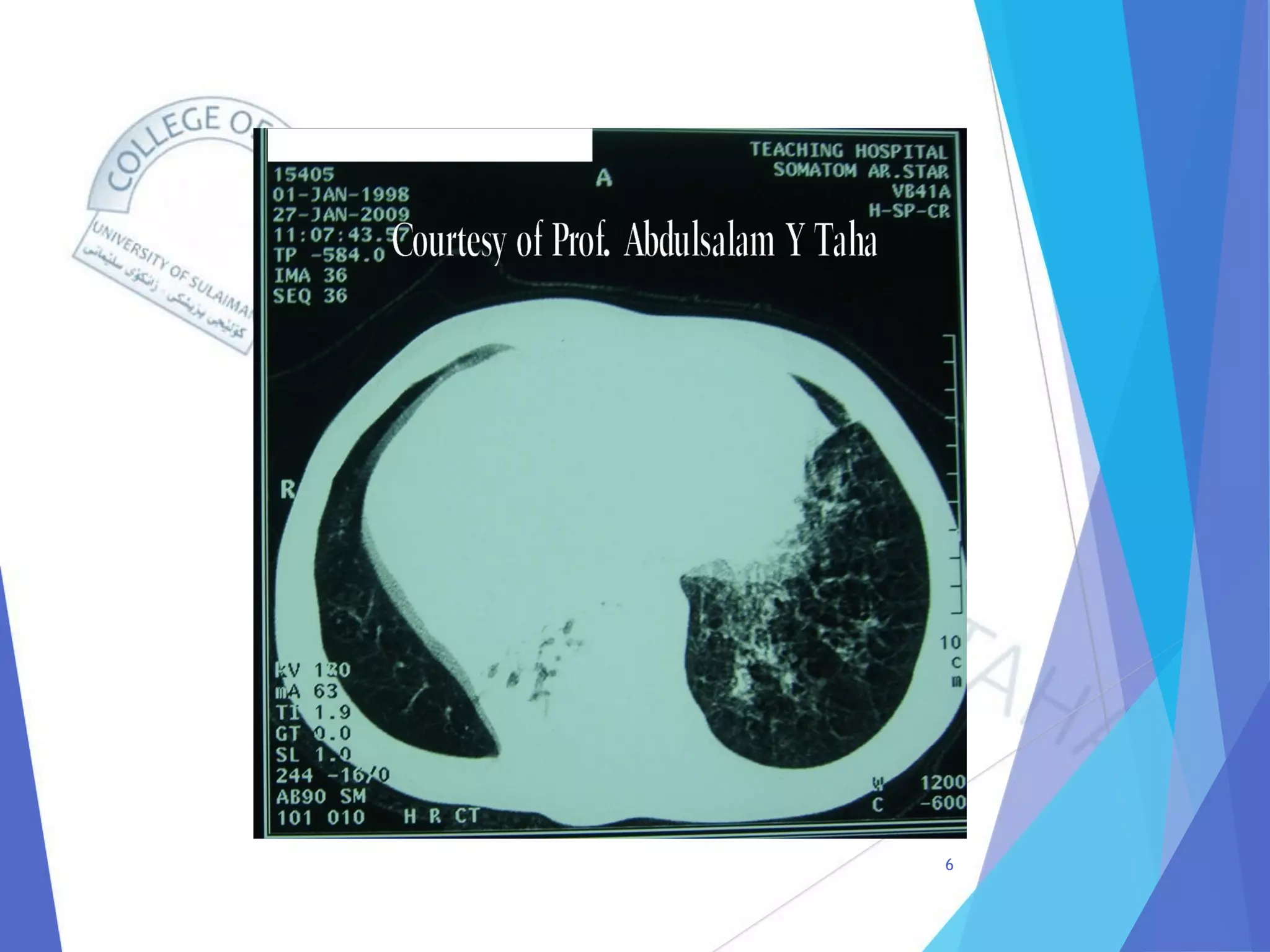 Right Middle and Lower Pulmonary Bilobectomy for Bronchiectasis.pdf