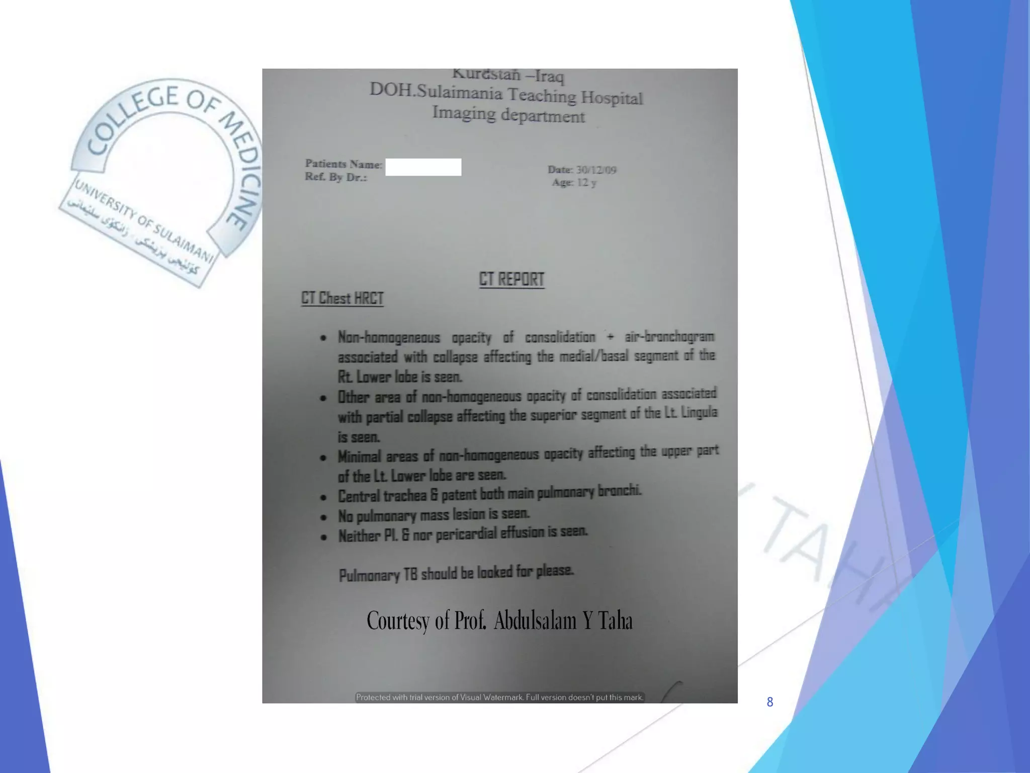 Right Middle and Lower Pulmonary Bilobectomy for Bronchiectasis.pdf