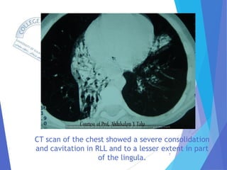 Right Middle and Lower Pulmonary Bilobectomy for Bronchiectasis.pdf