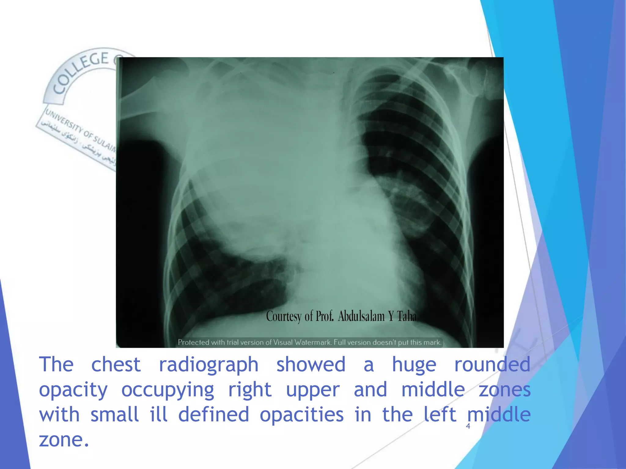 Right Upper Lobectomy for a Huge Intact Pulmonary Hydatid Cyst in a ...