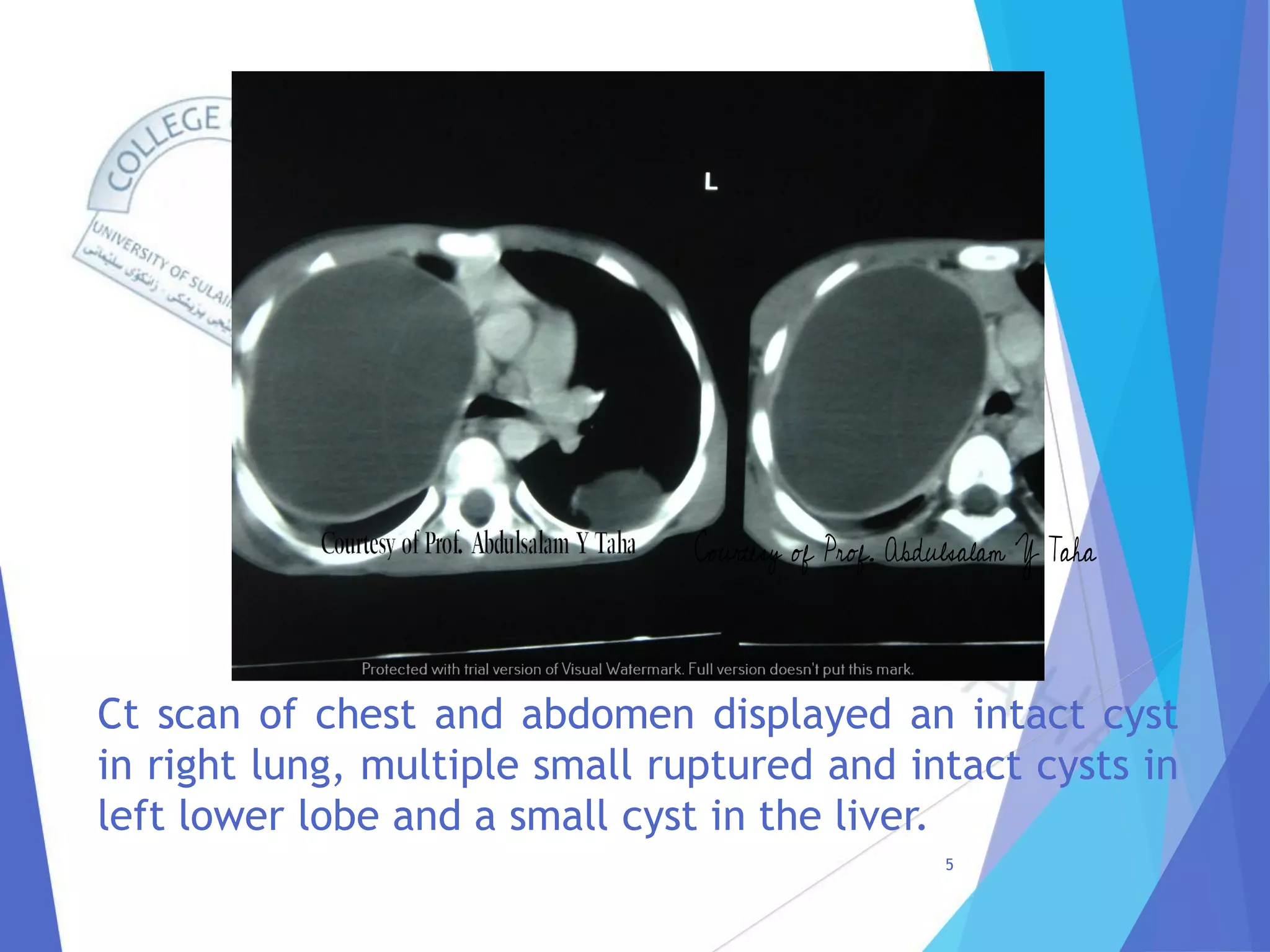 Right Upper Lobectomy for a Huge Intact Pulmonary Hydatid Cyst in a ...