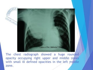 Right Upper Lobectomy for a Huge Intact Pulmonary Hydatid Cyst in a ...