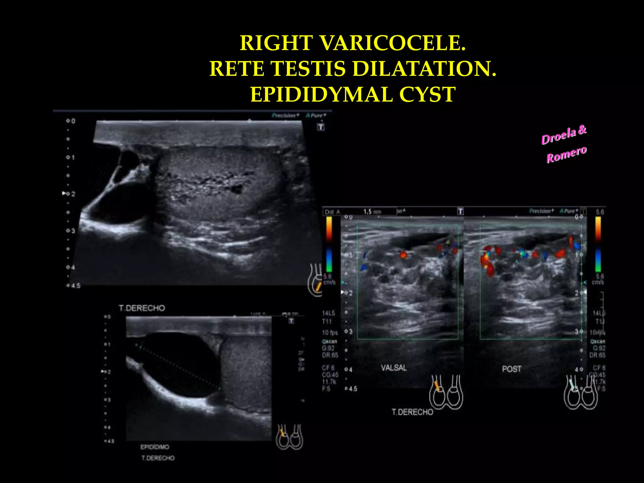 Right varicocele. Ultrasound. | PPT | Reproductive Health | Diseases ...