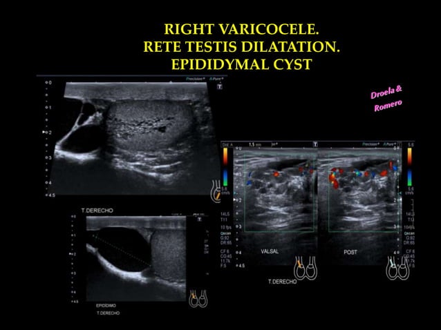 Varicocele Ultrasound