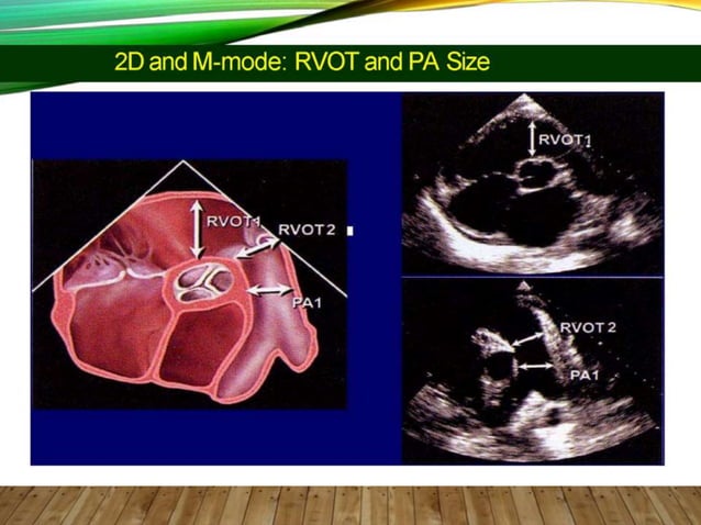 Right Ventricle Anatomy, Physiology & ECHO Assessment by Dr. Vaibhav ...