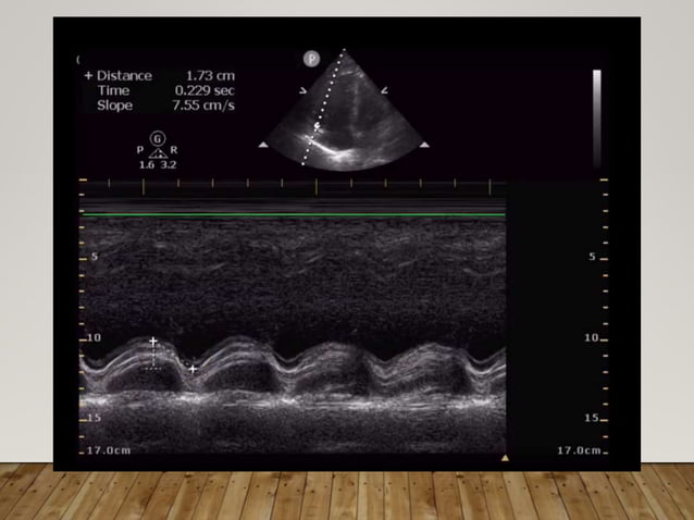 Right Ventricle Anatomy, Physiology & ECHO Assessment by Dr. Vaibhav ...