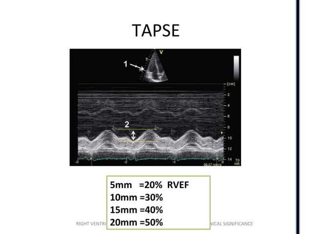 Right ventricle (RV) anatomy and functions