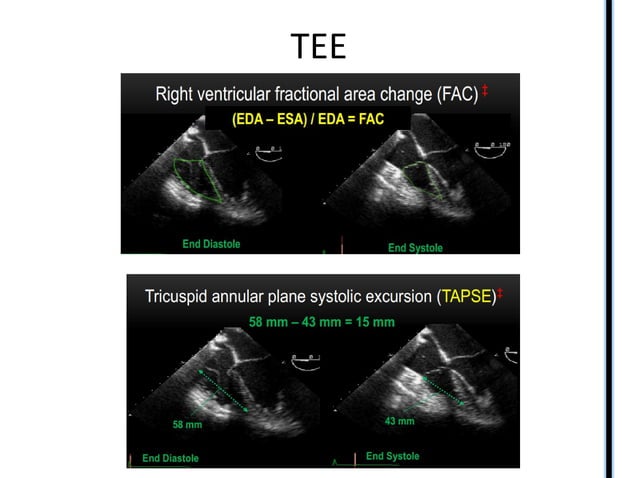 Right ventricle (RV) anatomy and functions