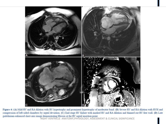 Right ventricle (RV) anatomy and functions