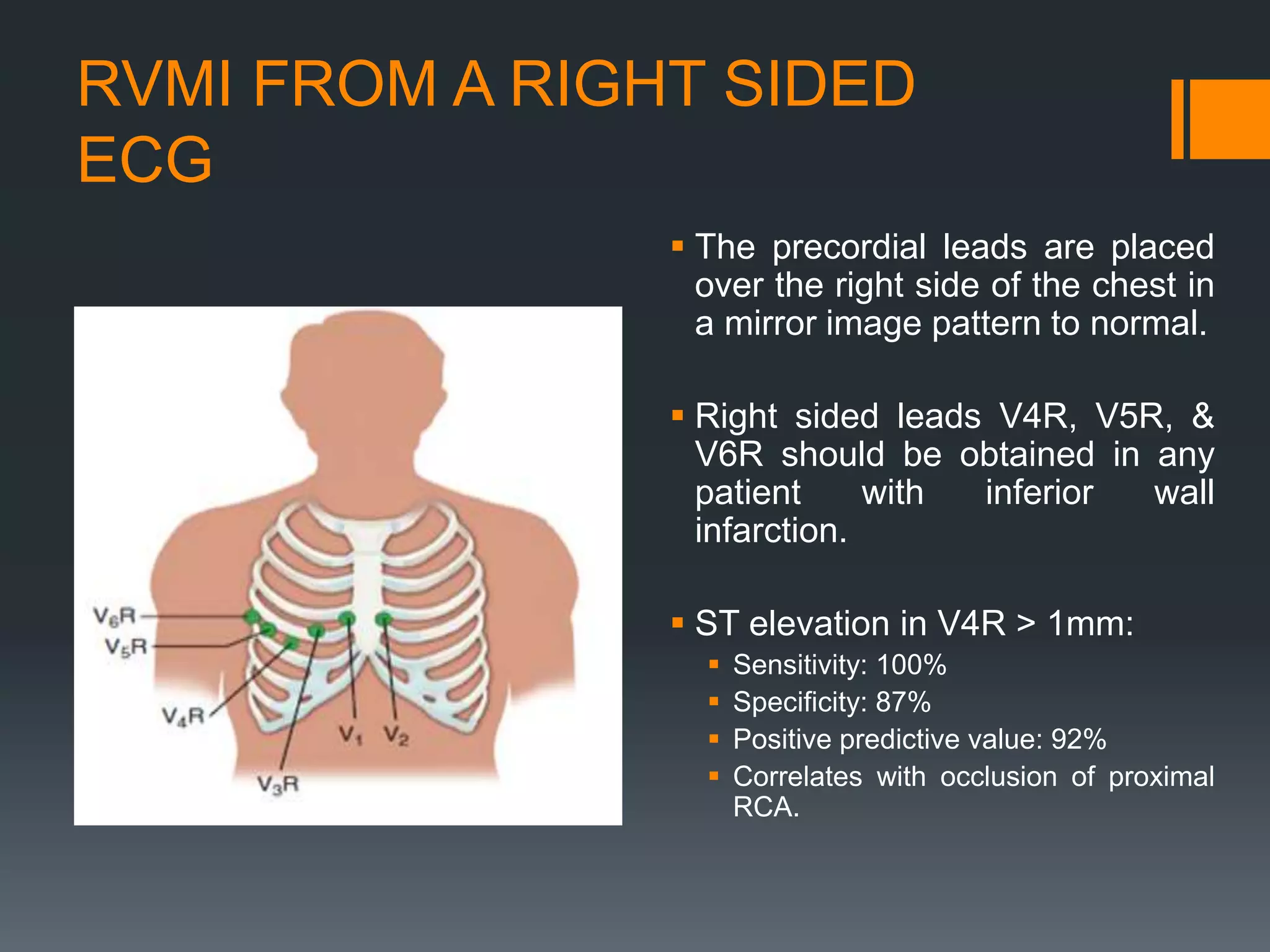 Right ventricular infarction | PPTX