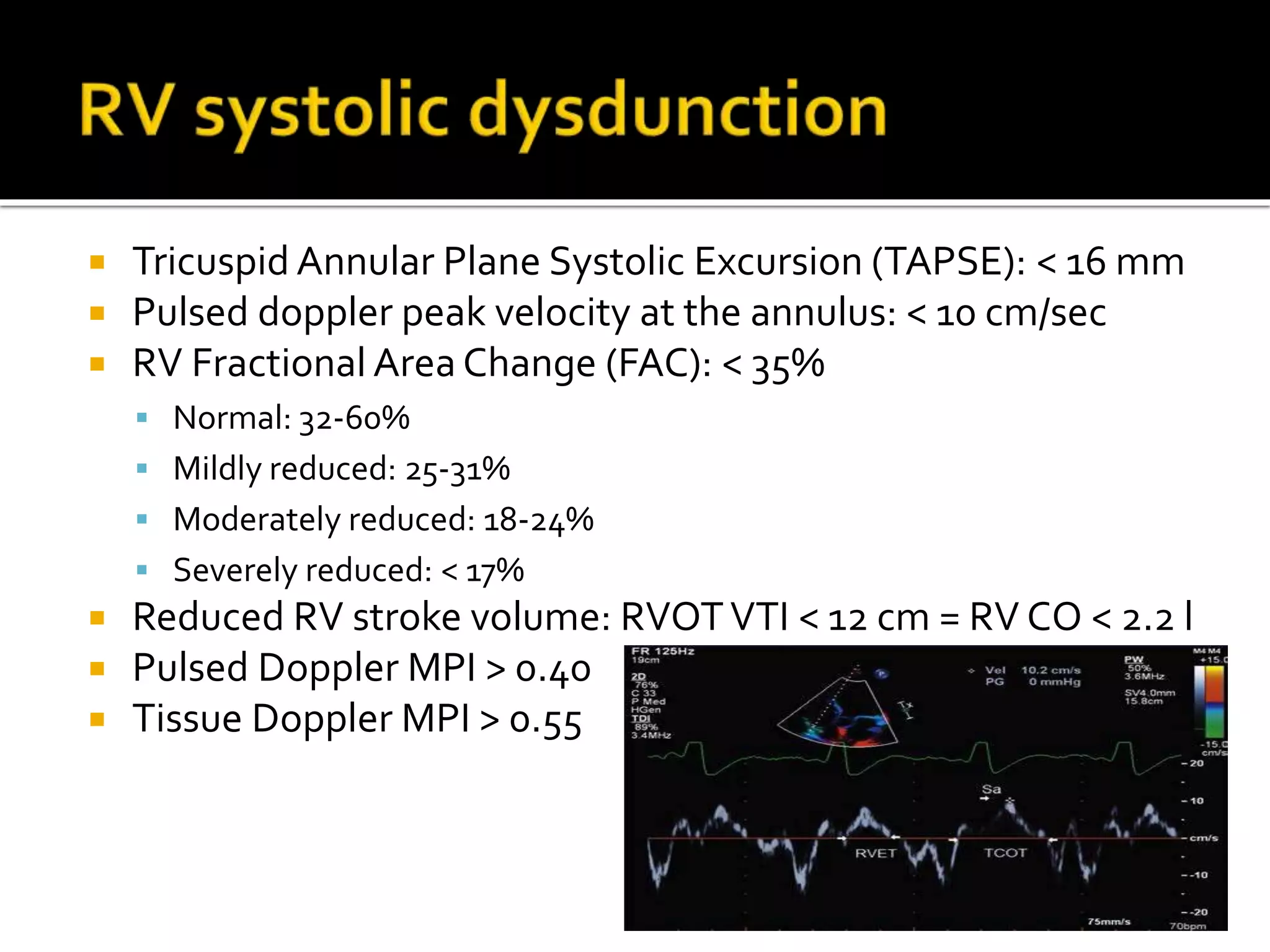 Right ventricular infarction | PPTX