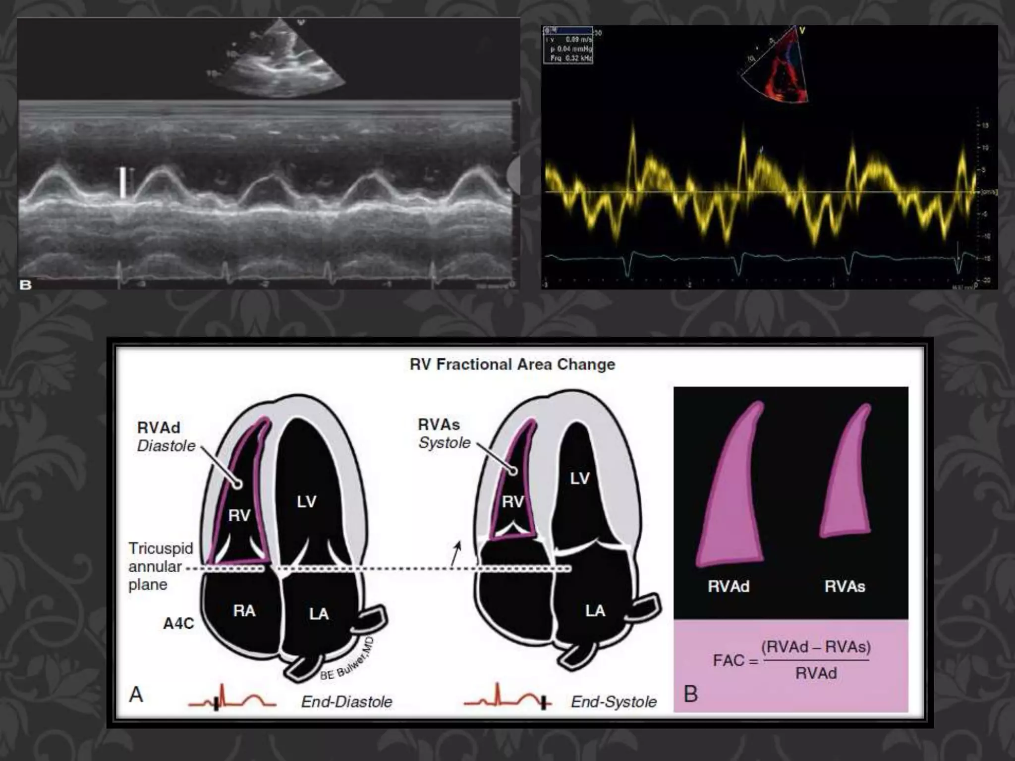 Right ventricular infarction | PPTX