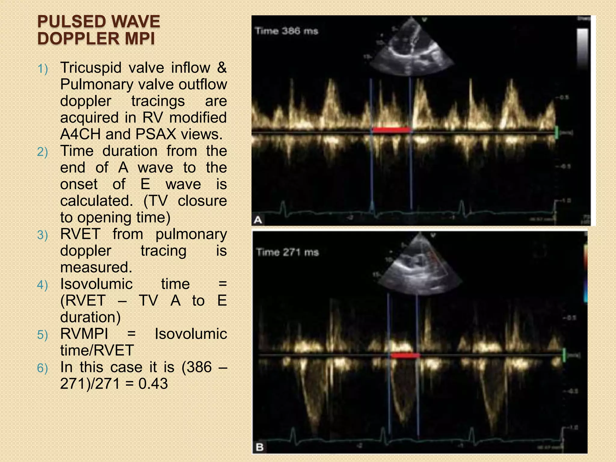 Right ventricular infarction | PPTX