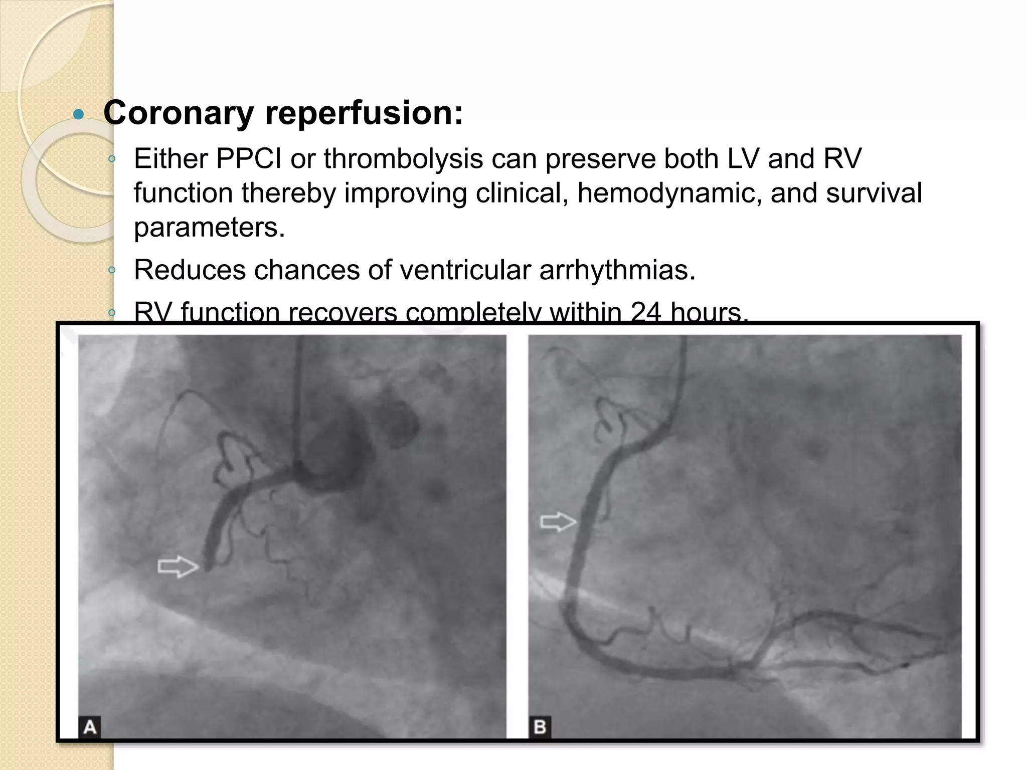 Right ventricular infarction | PPTX