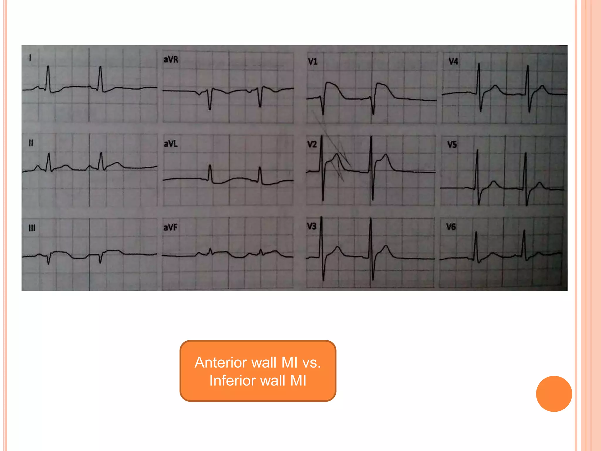 Right ventricular infarction | PPTX
