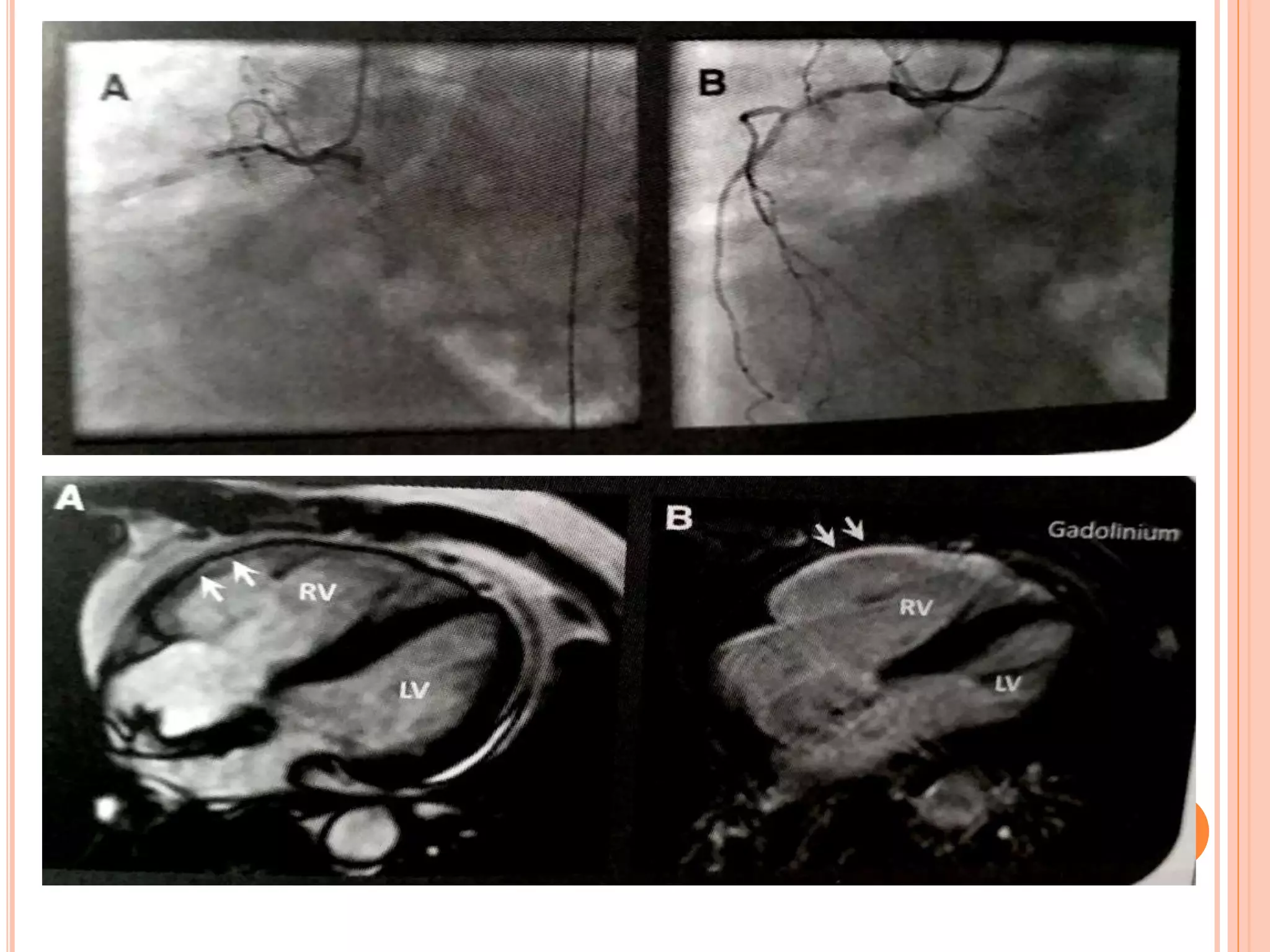 Right ventricular infarction | PPTX