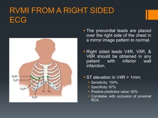 Right ventricular infarction | PPTX