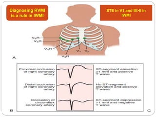 Right ventricular infarction | PPTX