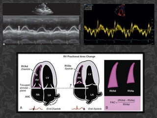 Right ventricular infarction | PPTX