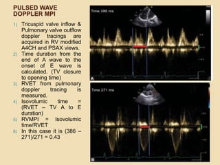 Right ventricular infarction | PPTX