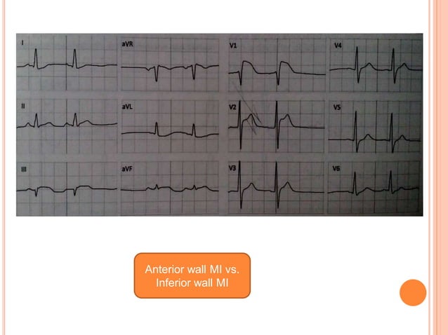 Right ventricular infarction | PPTX