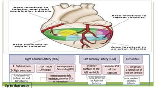 Right ventricular MI | PPT