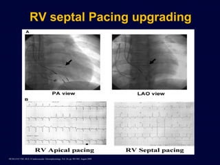 Right ventricular pacing revisited | PPT