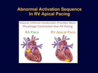 Right ventricular pacing revisited | PPT