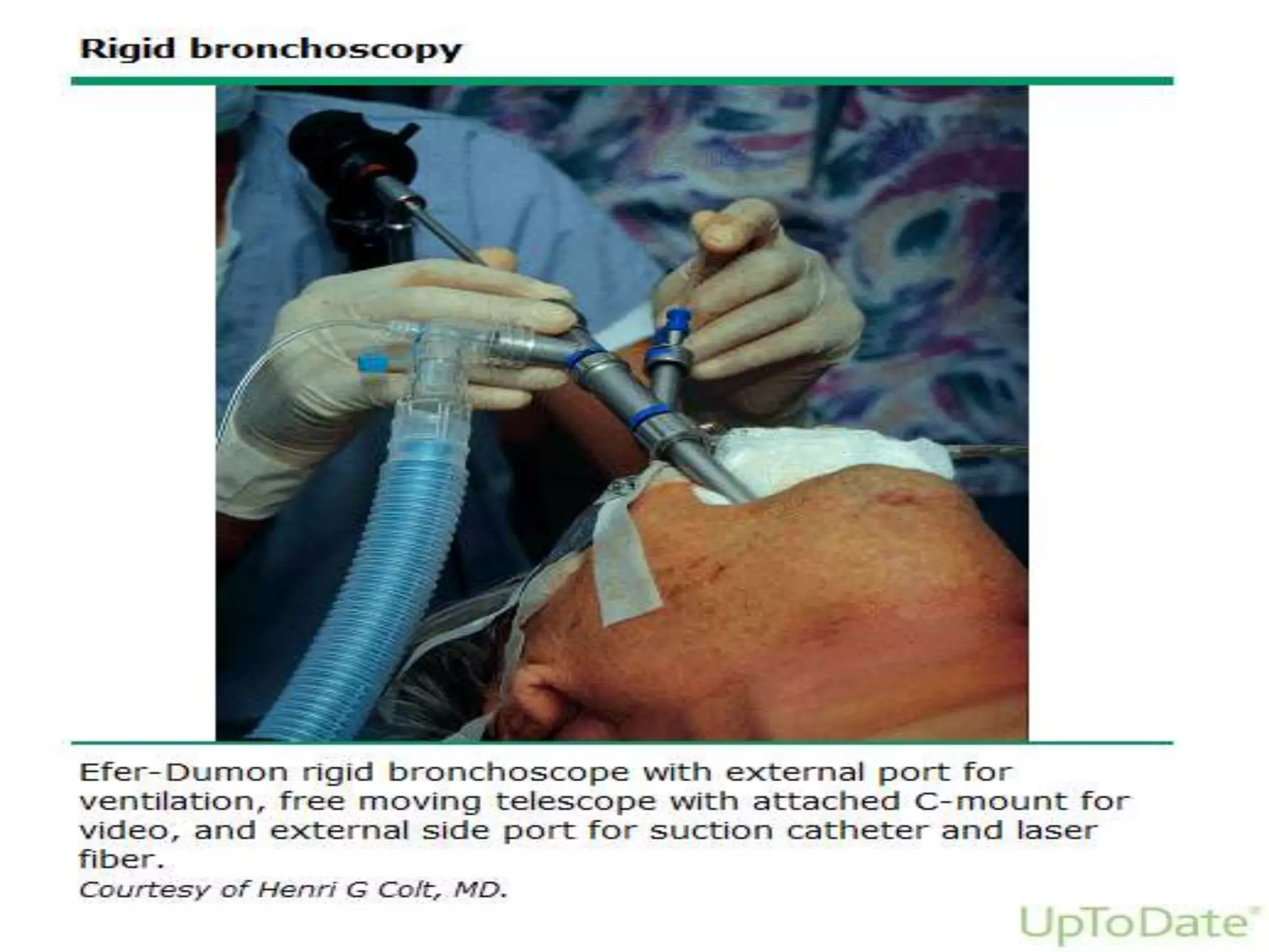 Rigid bronchoscopy | PPTX