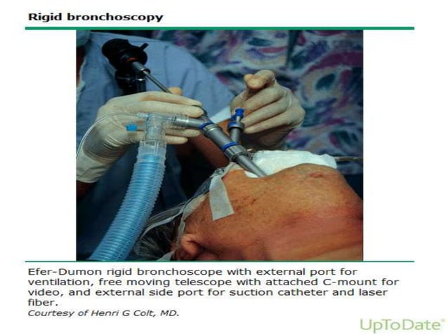 Rigid bronchoscopy | PPTX | Lung and Respiratory Health | Diseases and ...