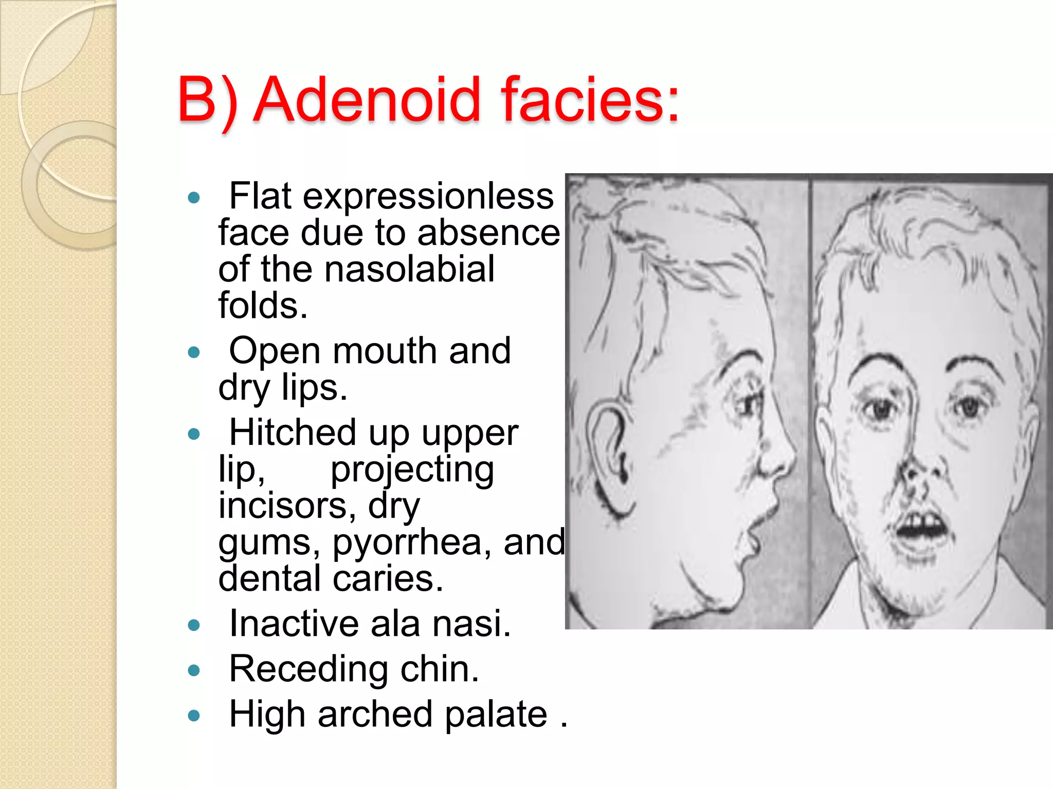 ADENOIDS&ADENOIDECTOMY BY ROOHIA | PPT