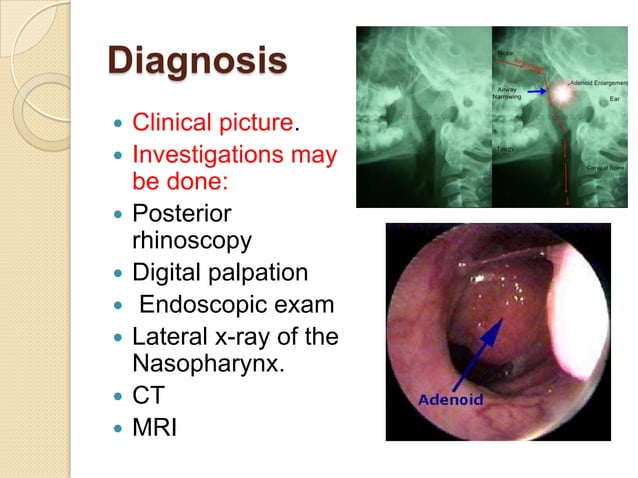ADENOIDS&ADENOIDECTOMY BY ROOHIA | PPT