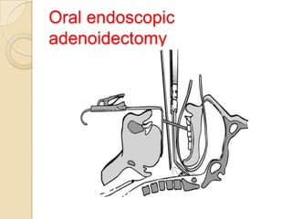 ADENOIDS&ADENOIDECTOMY BY ROOHIA | PPTX