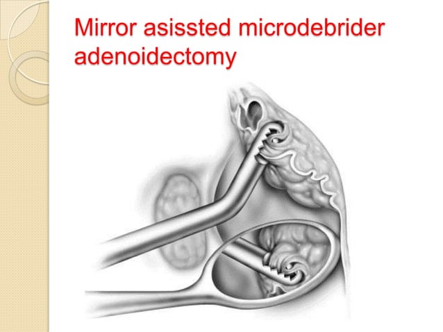 ADENOIDS&ADENOIDECTOMY BY ROOHIA | PPT