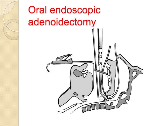 ADENOIDS&ADENOIDECTOMY BY ROOHIA