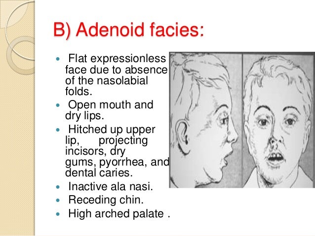 ADENOIDS&ADENOIDECTOMY BY ROOHIA