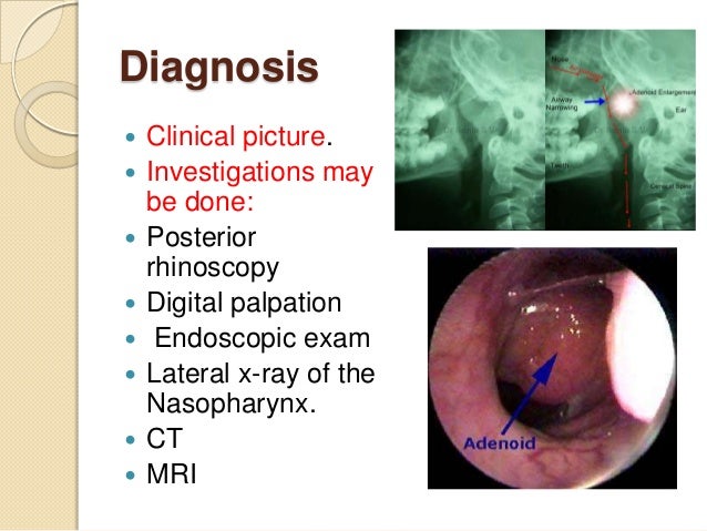 ADENOIDS&ADENOIDECTOMY BY ROOHIA