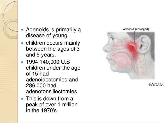 Adenoids Surgery