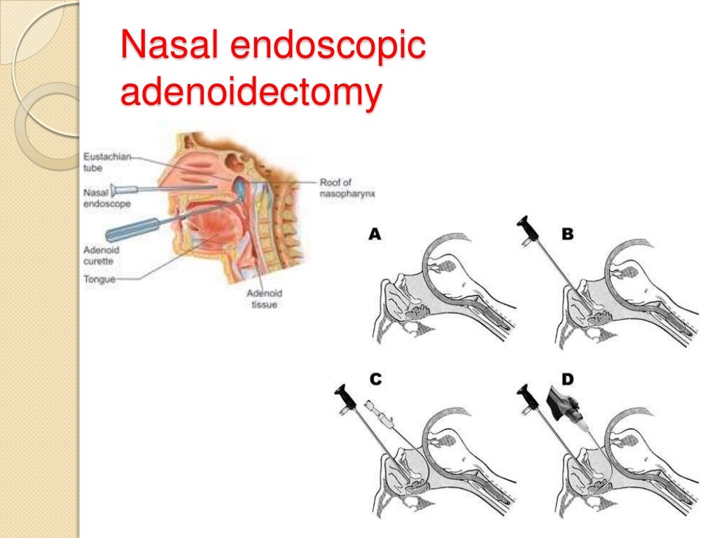 ADENOIDS&ADENOIDECTOMY BY ROOHIA