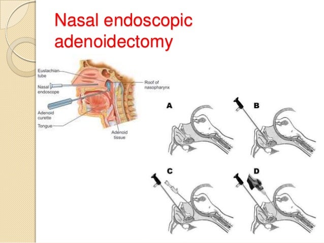 ADENOIDS&ADENOIDECTOMY BY ROOHIA