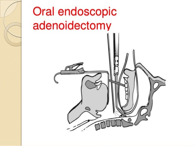 Adenoidectomy Scar