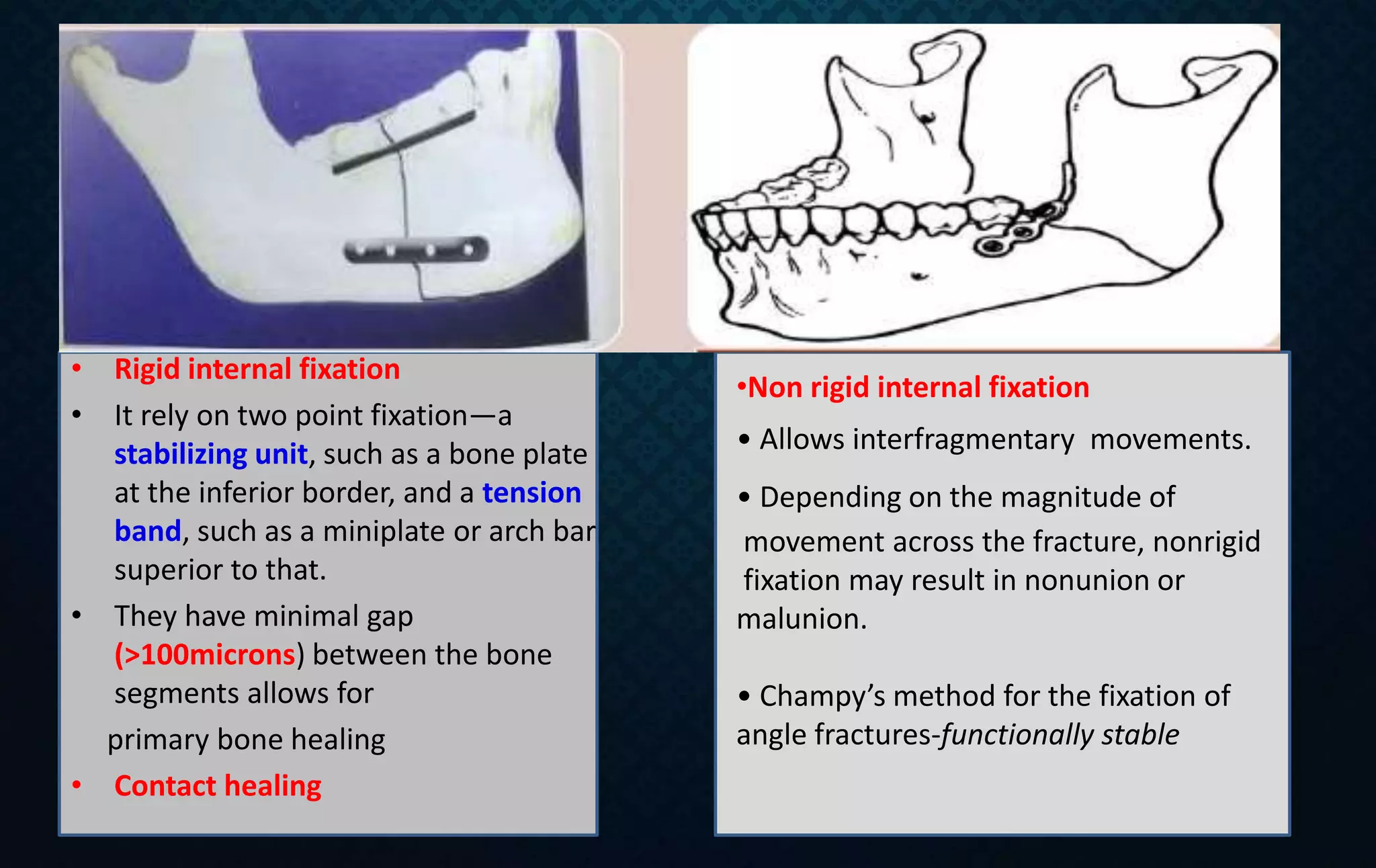 Rigid internal fixation | PPTX