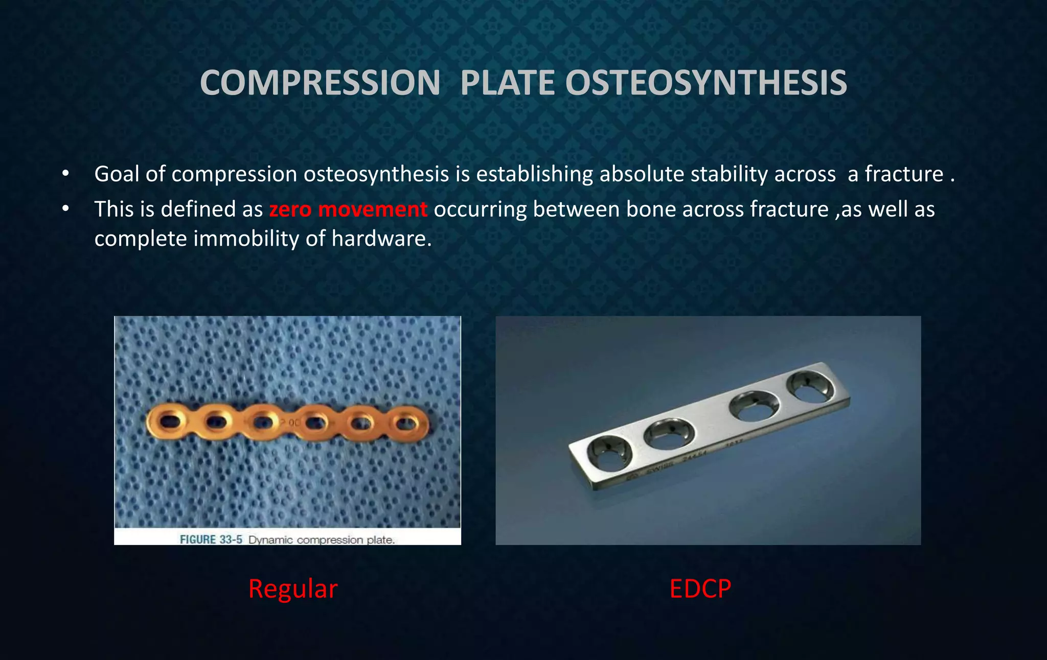Rigid internal fixation | PPTX