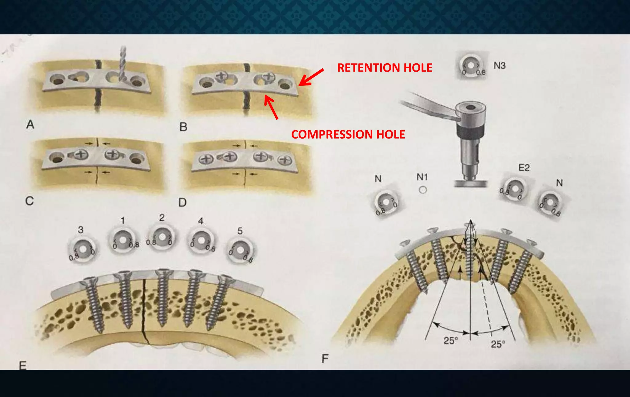 Rigid internal fixation | PPTX