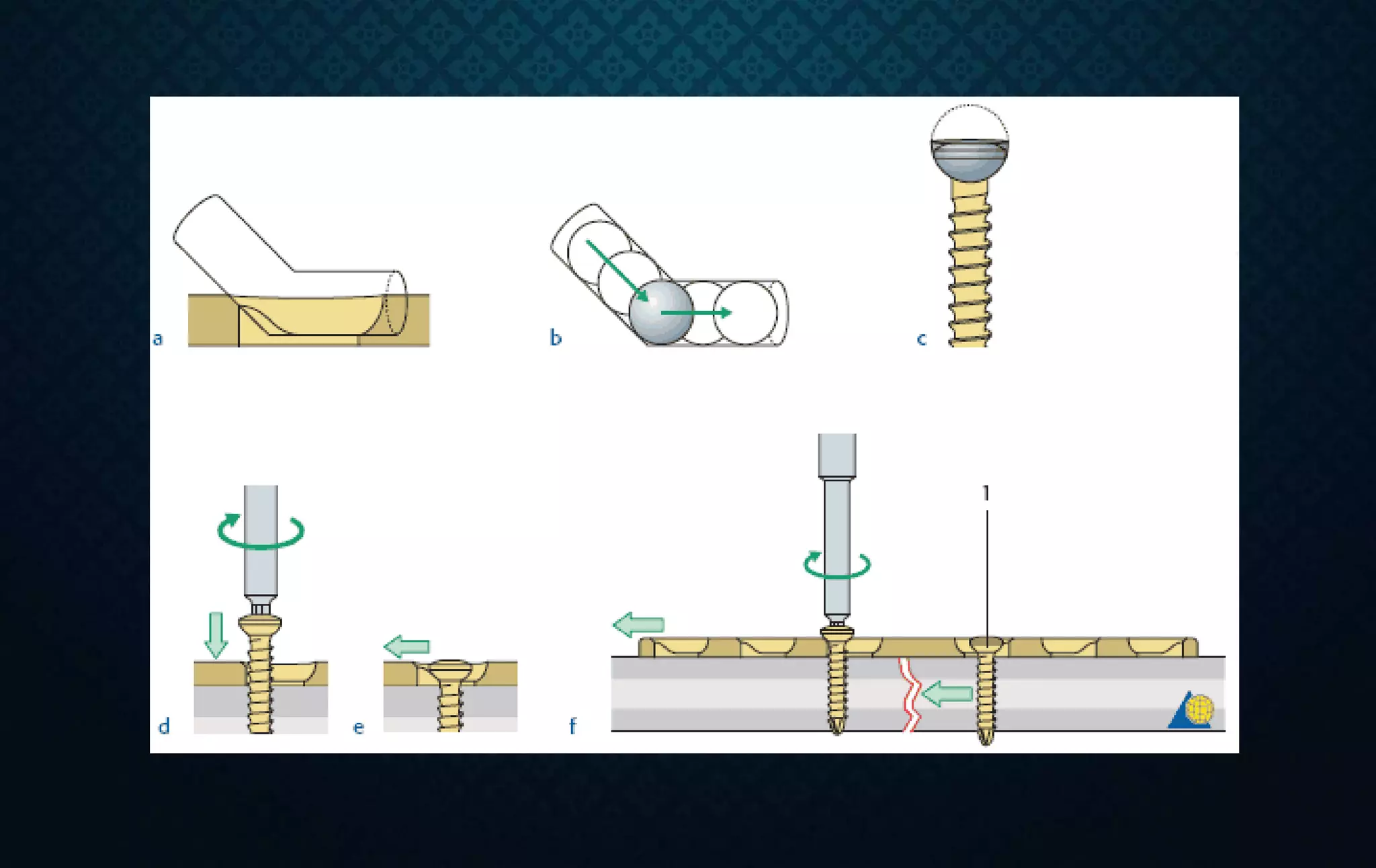 Rigid internal fixation | PPTX
